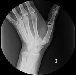 Rizartrosis, artrosis o desgaste en la mano con solución – Sendagrup