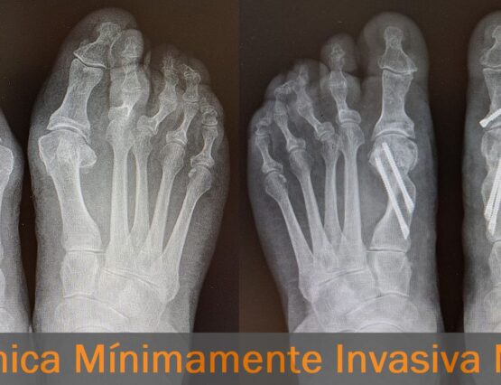 Quistes Mucoides en la mano: Clínica y Tratamiento - Sendagrup